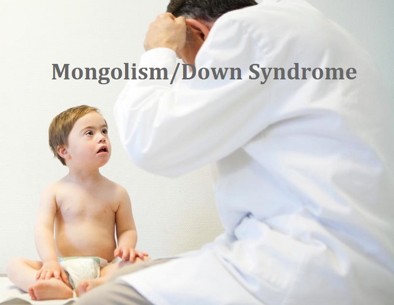 Mongolism - Down Syndrome Treatment – Neurotherapy India